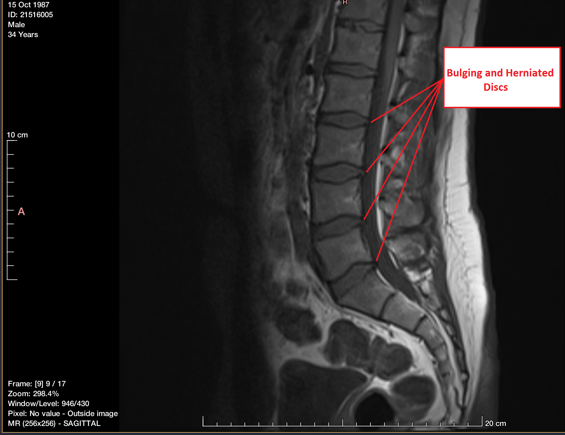 Herniated And Bulging Disc Diagnosis Causes And Treatments Mr Salus