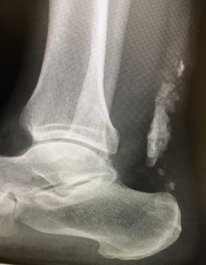 How to treat calcifications and adhesions - Mr Salus Sporting Lab