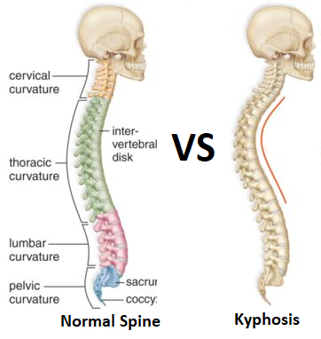 The best physiotherapy to fix kyphosis (hunchback) - Mr Salus Sporting Lab